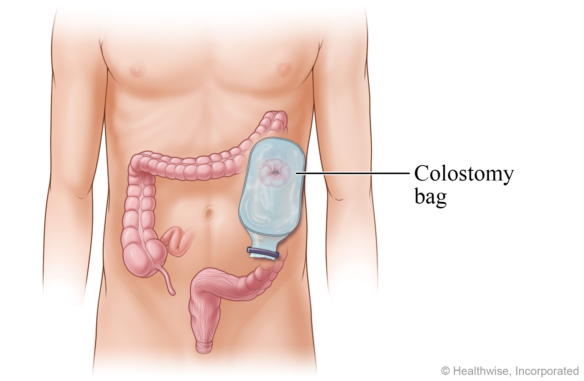 Colostomy CommonSpirit Health